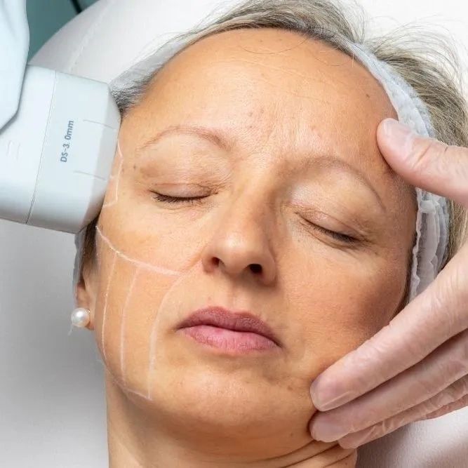 Everything you need to know about HIFU Skin Tightening