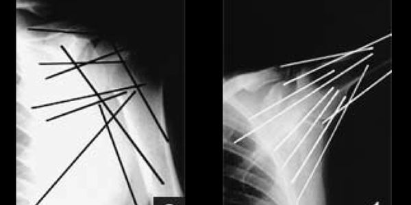 Zero position | DISLOCATION.COM.AU