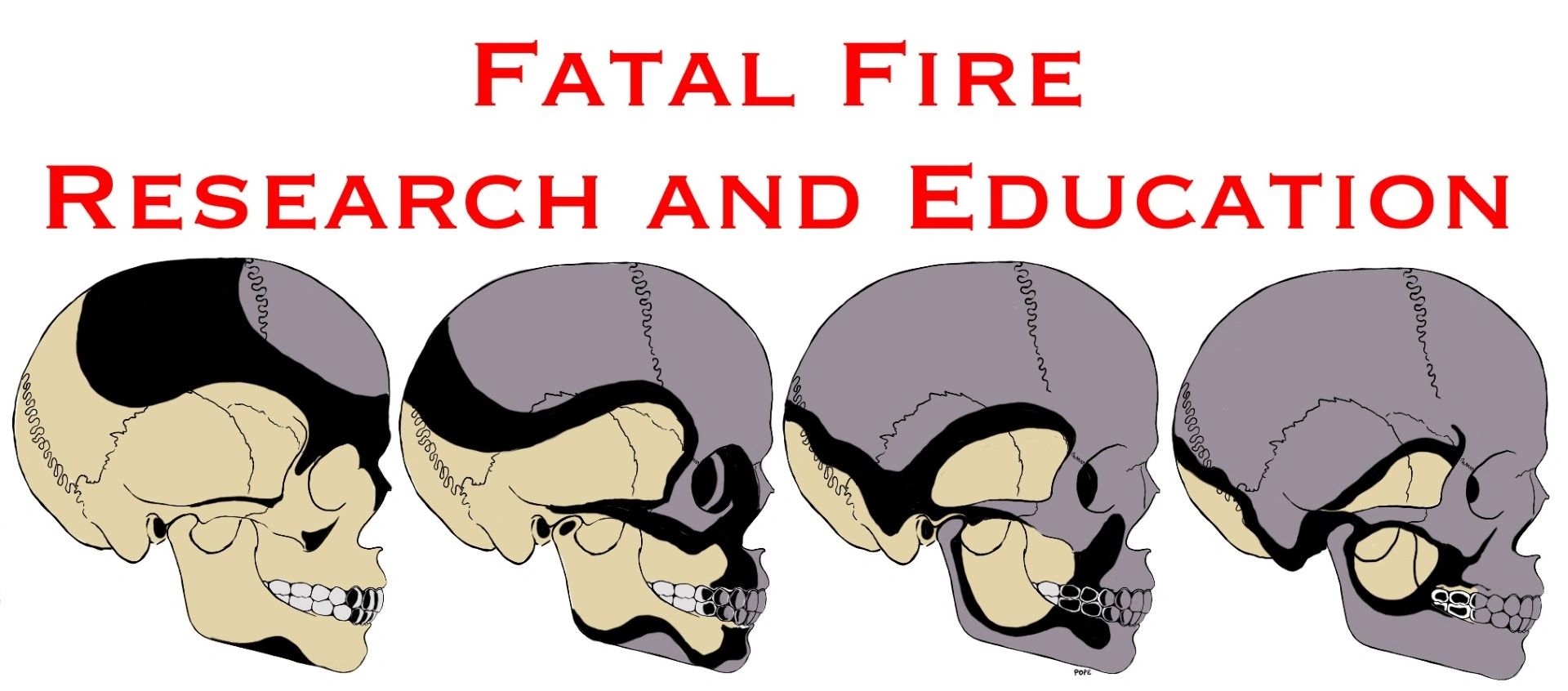 Fatal Fire Investigation of Burned Human Remains