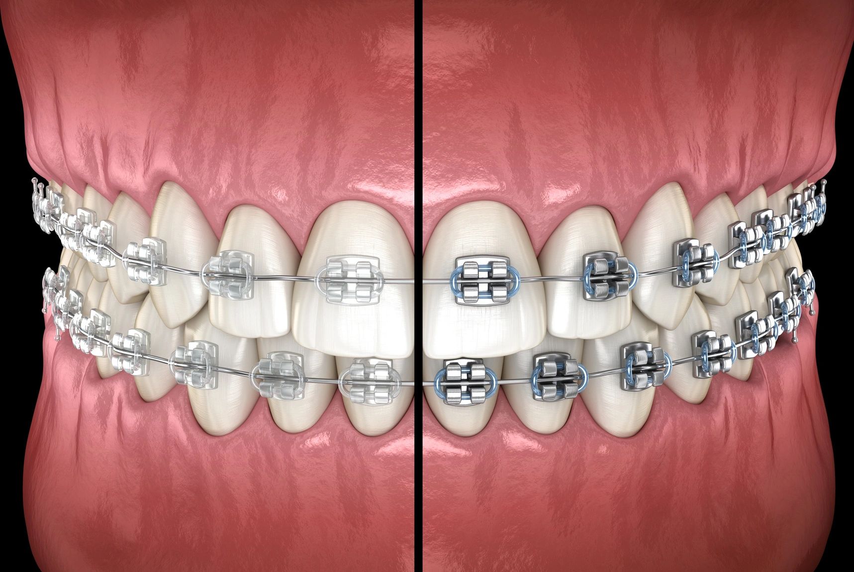 CHOOSING YOUR BRACES: DIFFERENT TYPES FOR YOUR ORTHODONTIC BRACES