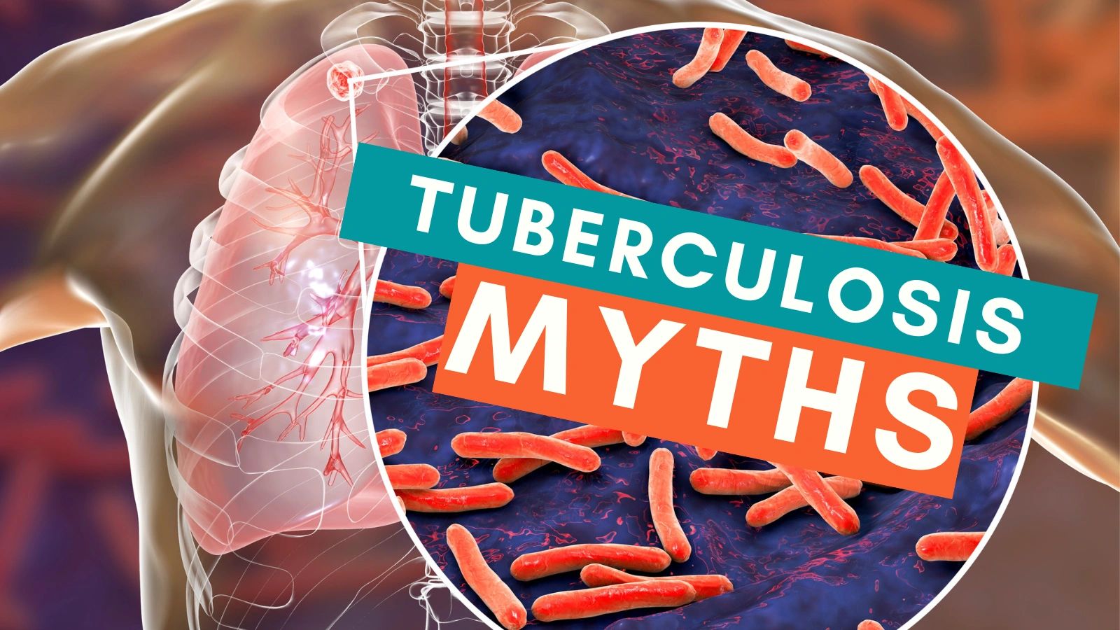 6 Myths About Tuberculosis