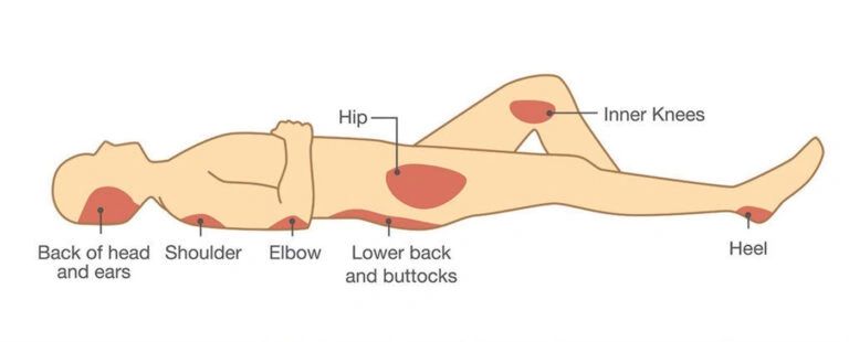 What Are The Best Ways To Prevent Bed Sores 0843