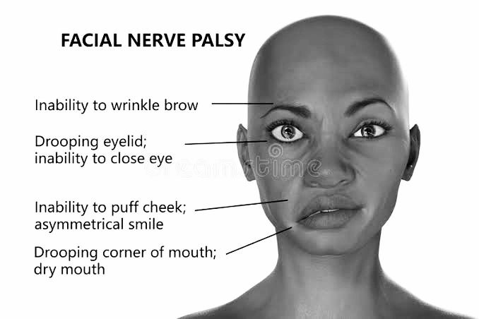What Is Facial Paralysis / Palsy?