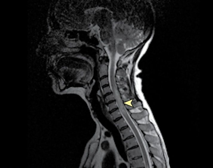 Diagnosis, Treatment, and Rehabilitation Of Transverse Myelitis.