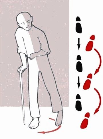 How to Prevent and Reverse Contractures After A Stroke.