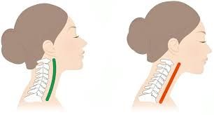 How to Correct a Loss of Cervical Lordosis