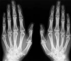 Radiografía o Rayos x de Mano en Artritis, utilidad diagnóstica?