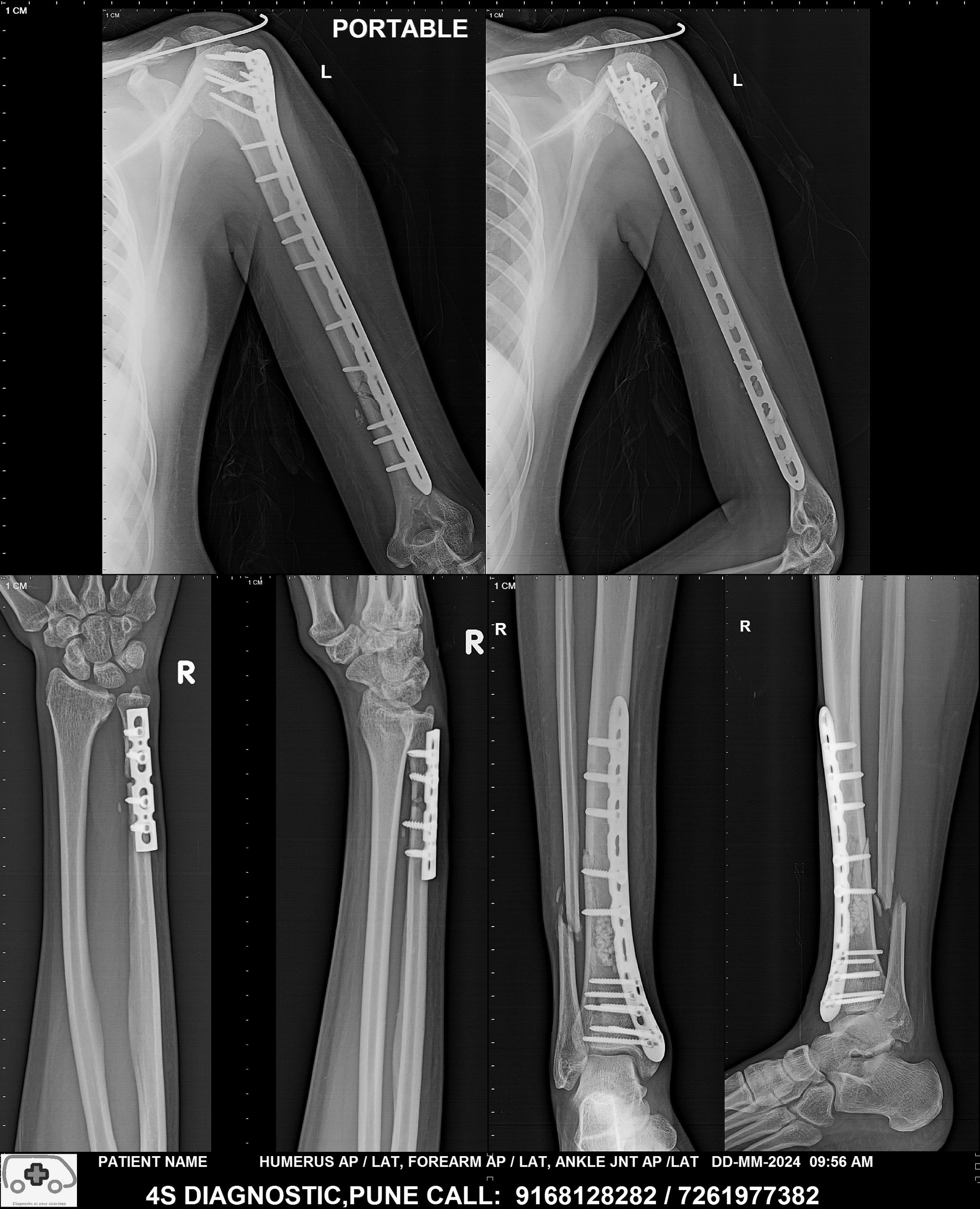 Get Your Post-Operative Follow-Up X-Ray Done at Your Home