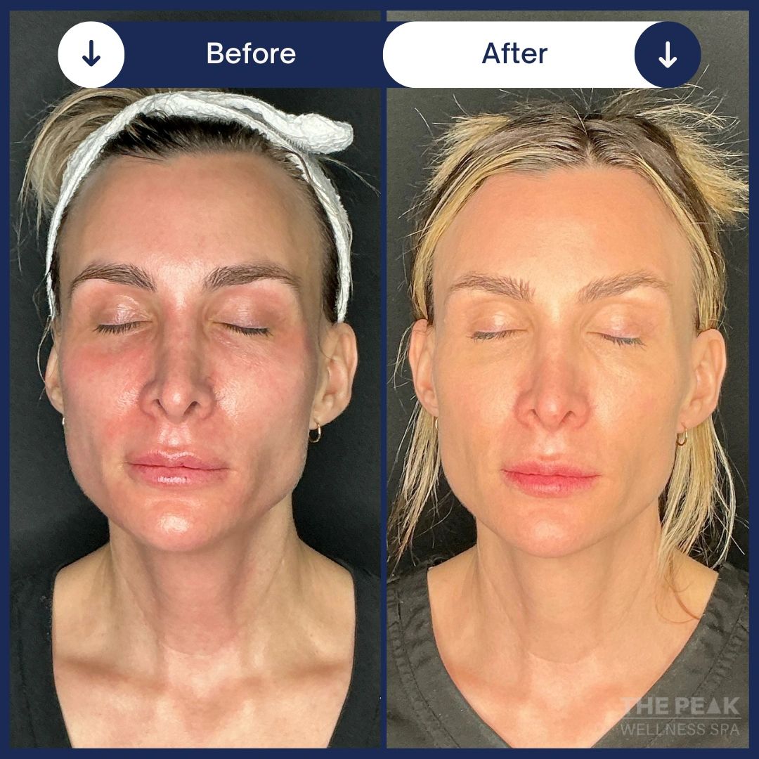 Transform Your Skin with the Helix Fusion CO2 Laser