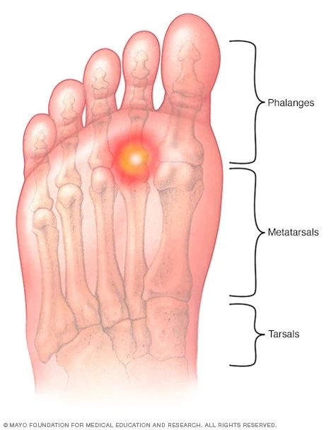 Understanding Metatarsalgia: Causes, Symptoms, and Treatment Understanding Metatarsalgia: Causes, Symptoms, and Treatment
