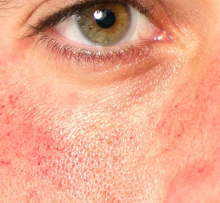 Understanding Ocular Rosacea: Causes, Symptoms, and Treatment