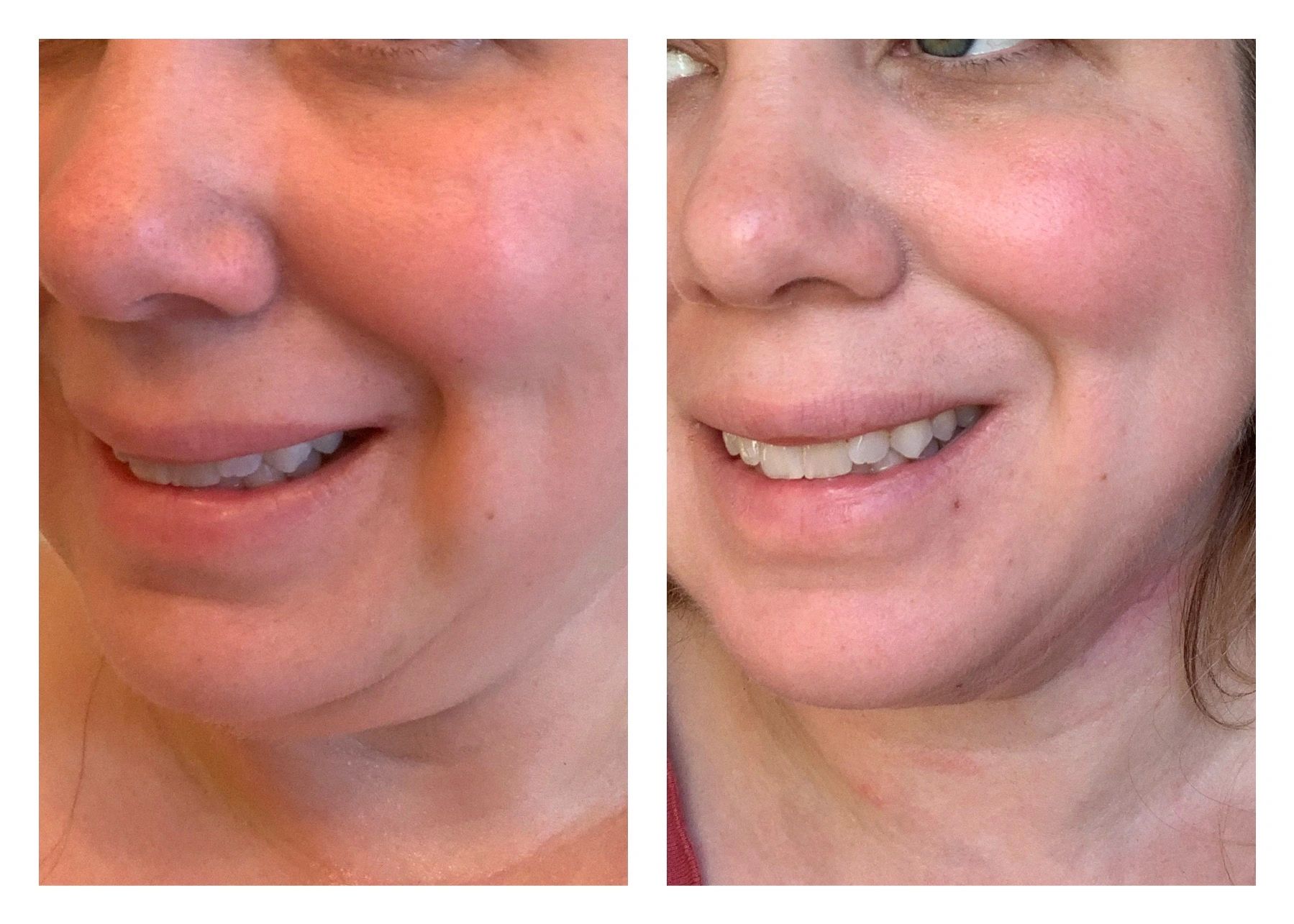 The Benefits of PDO Threads for a Double Chin