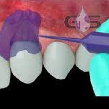 PeriAcryl | Surgical Solutions