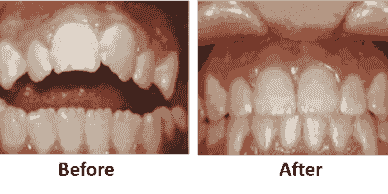 Common Orthodontic Issues | Johnston Orthodontics