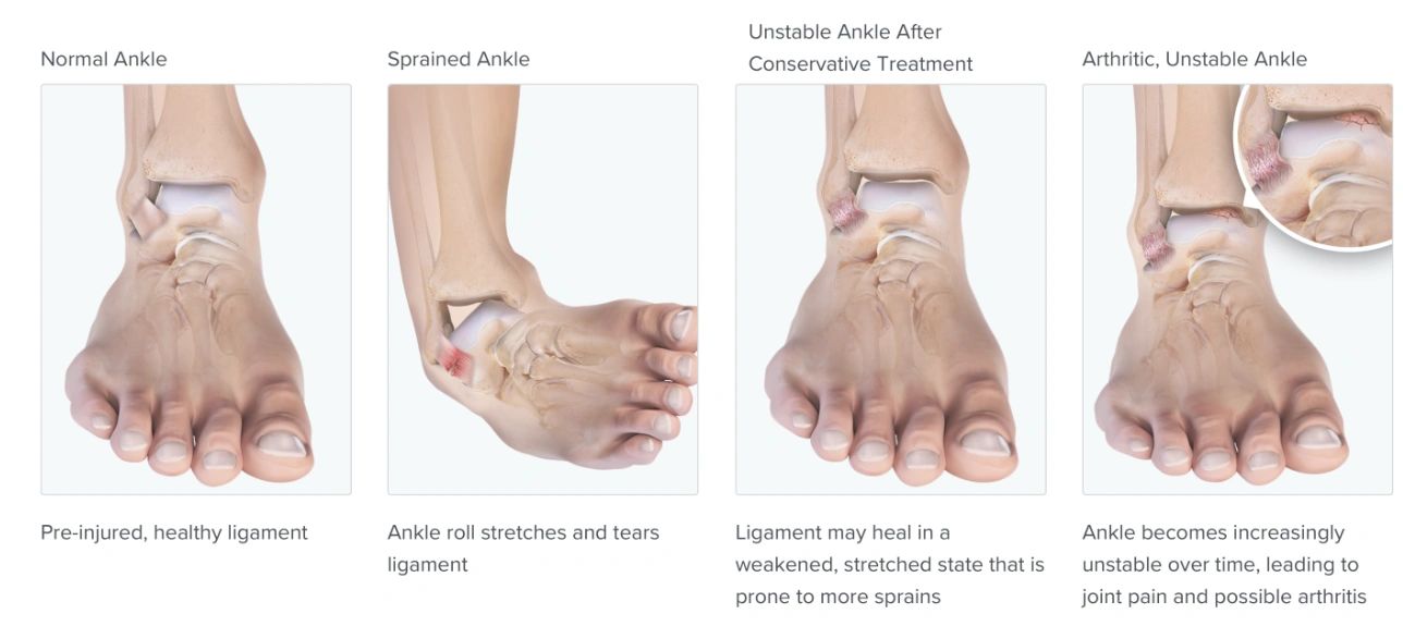 Ankles "give out" or roll? It may be Chronic Ankle Instability.