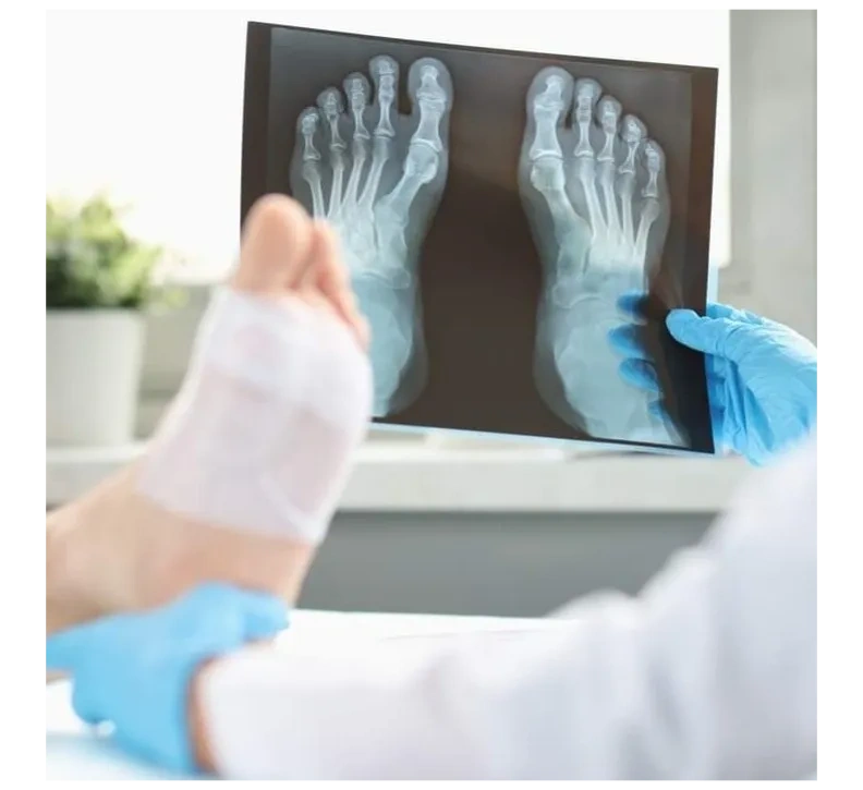 Bone Tumors of the Foot