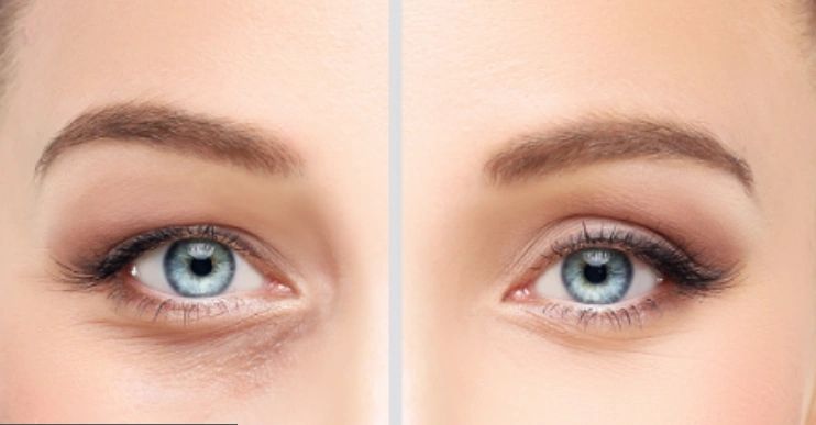 Glycation & AGEs: What are they and why sugar affects ageing