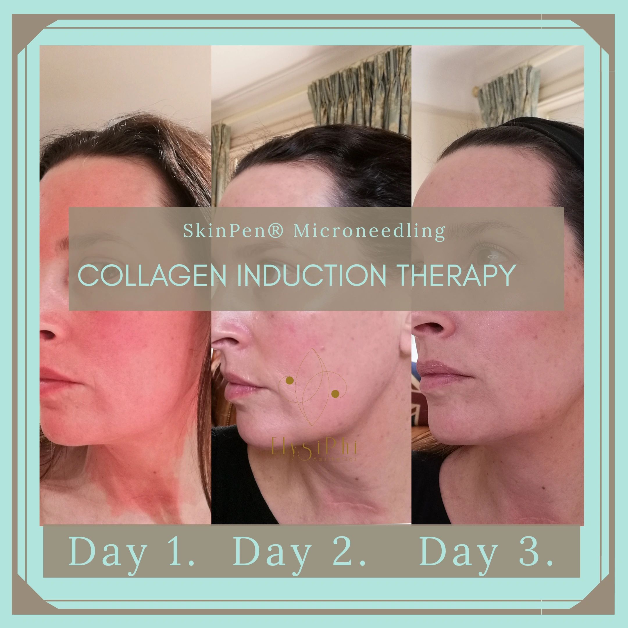 SkinPen® Precision Micro-needling
