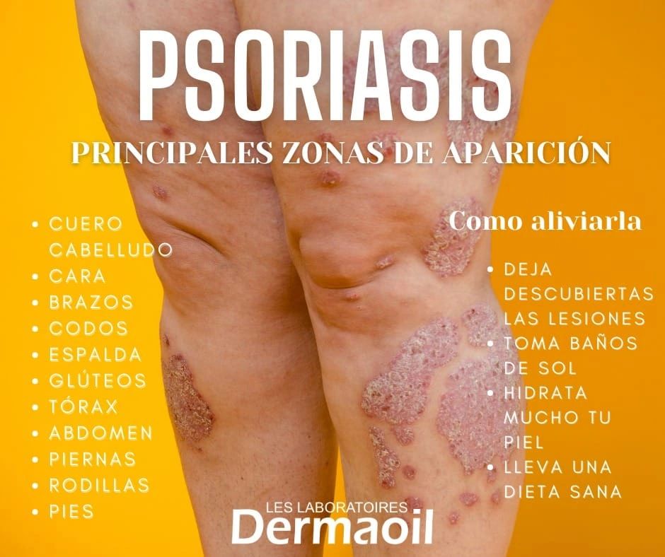 PSORIASIS: Principales zonas de aparición