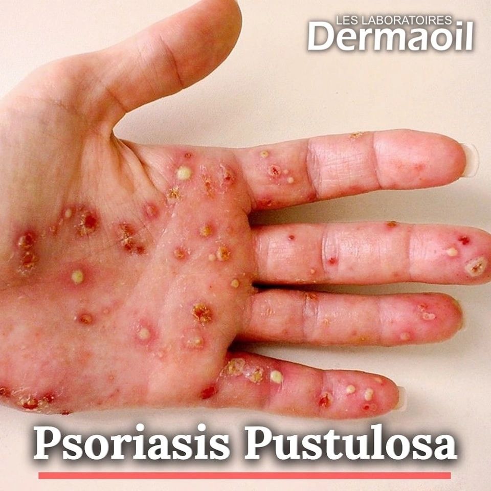 Psoriasis Pustulosa