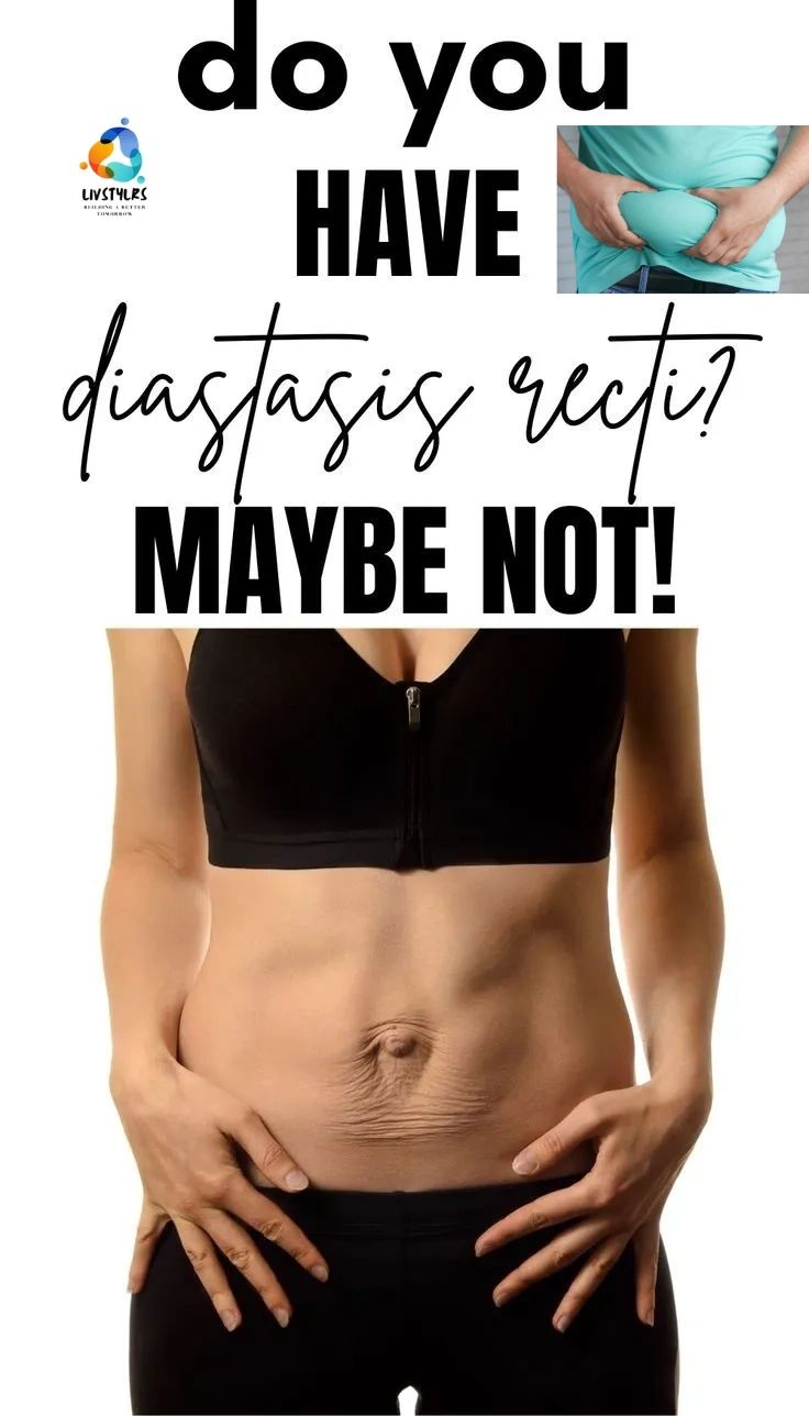 Diastasis Recti:
