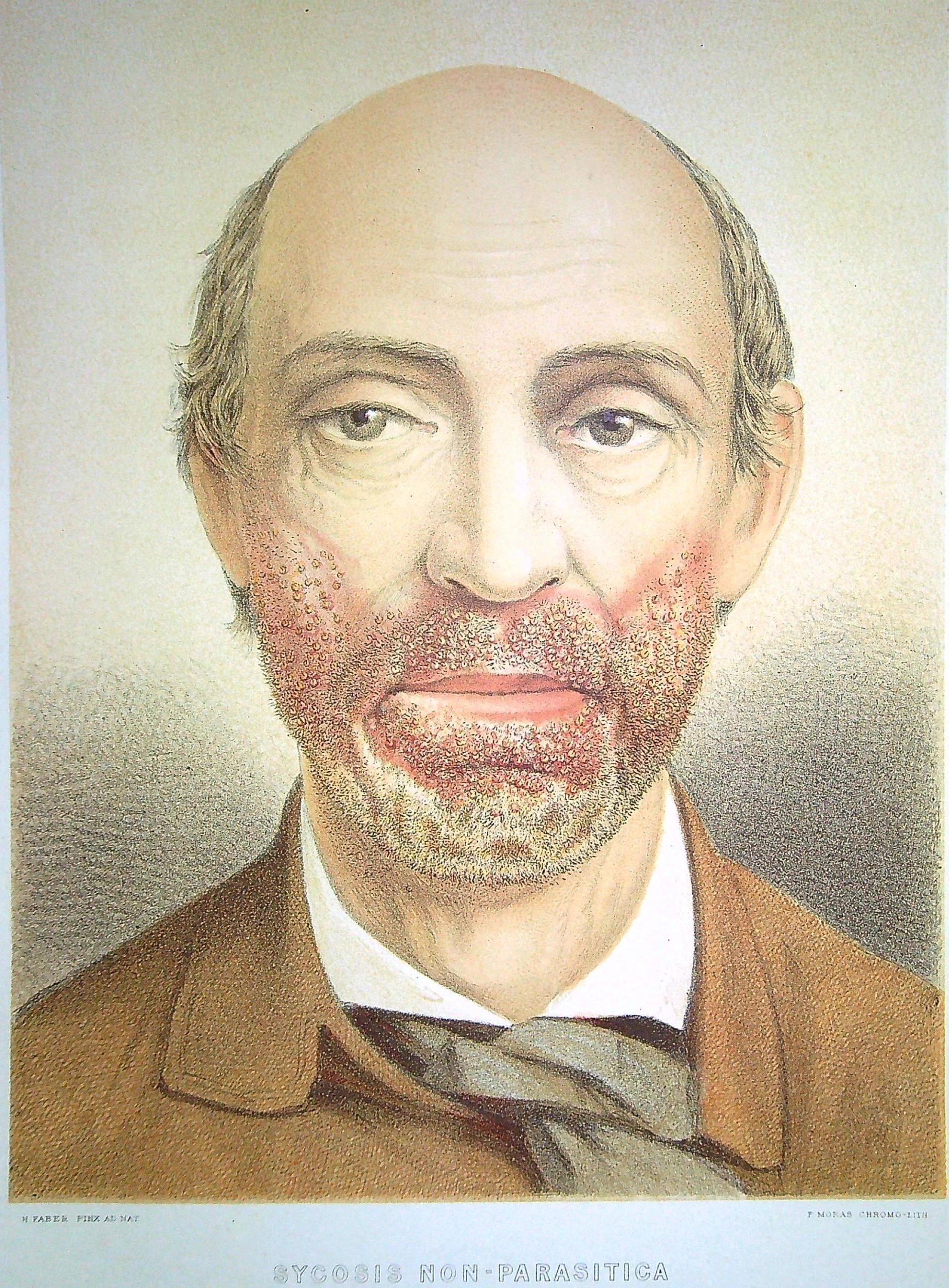 On Louis A. Duhring's Atlas of Skin Diseases