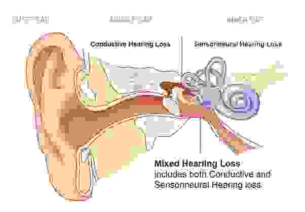 Mixed Hearing Loss | Bone Conduction Hearing Solutions