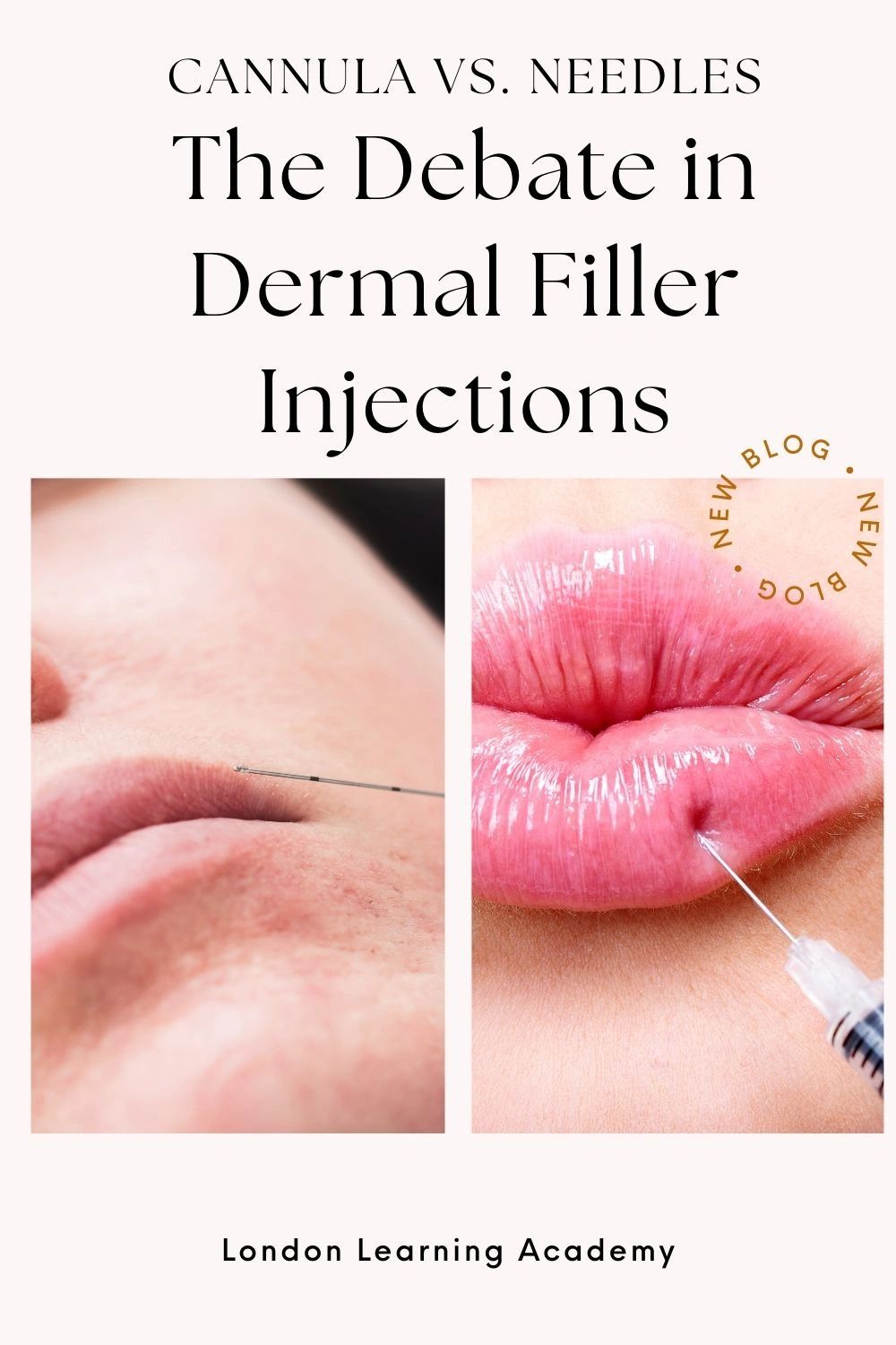 Cannula vs. Needles: The Debate in Dermal Filler Injections