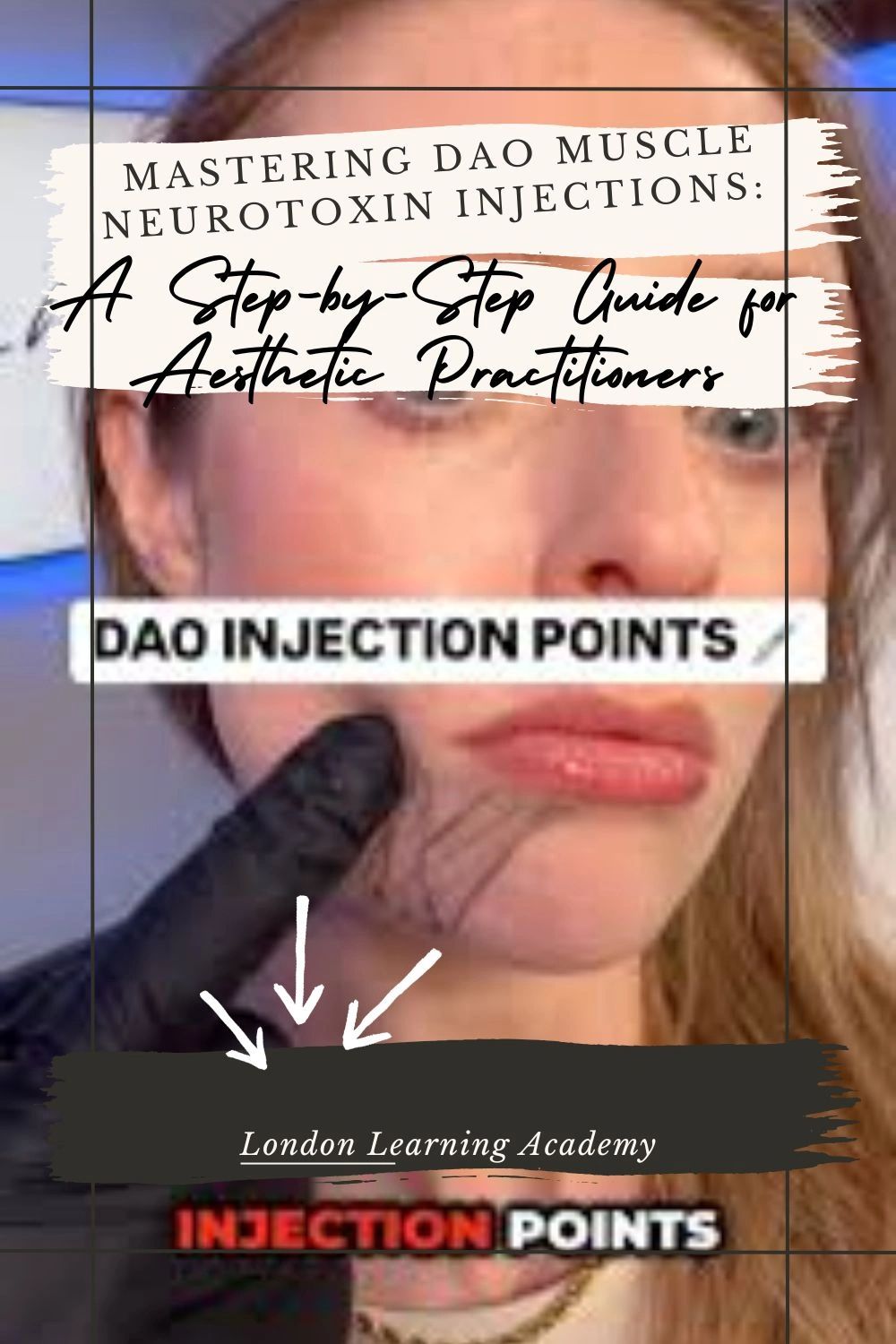 Mastering DAO Muscle Neurotoxin Injections