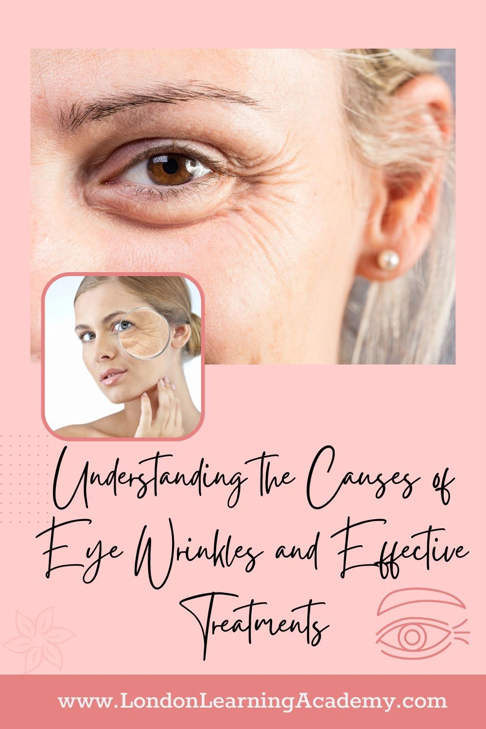 Understanding the Causes of Eye Wrinkles and Effective Treatments