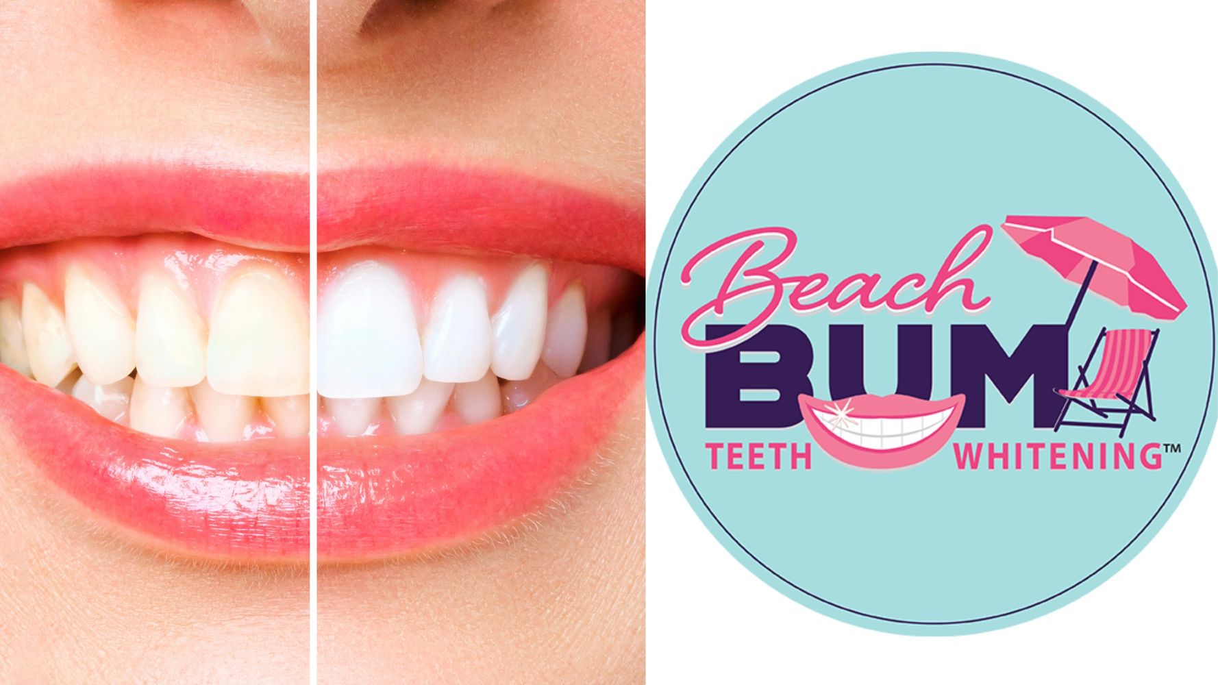 Beach Bum Teeth Whitening