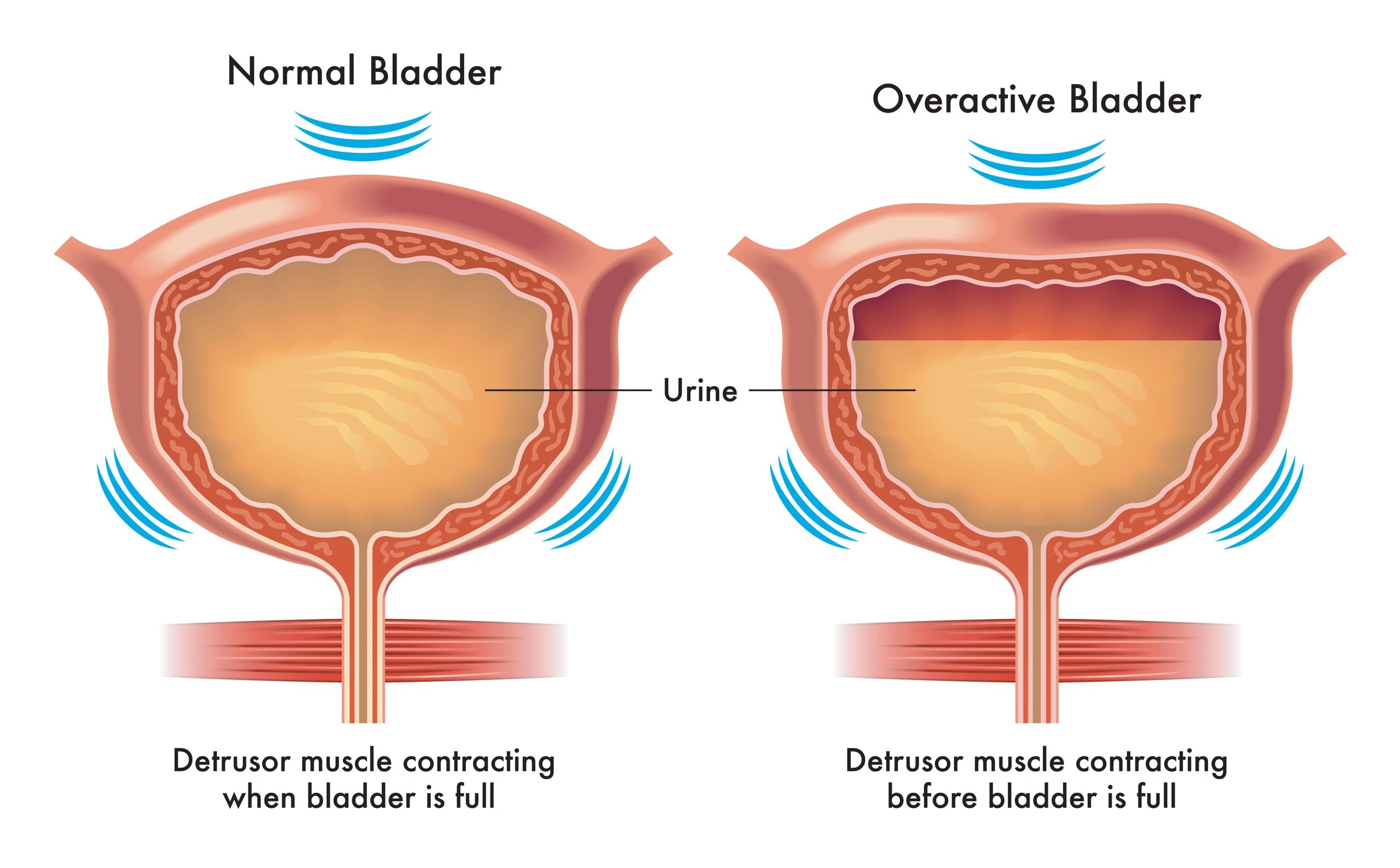 Overactive Bladder Nexus Letters