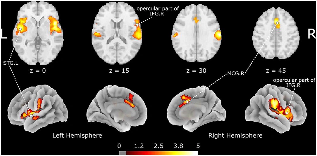 How Acupuncture Affects the Brain: What fMRI Research Reveals