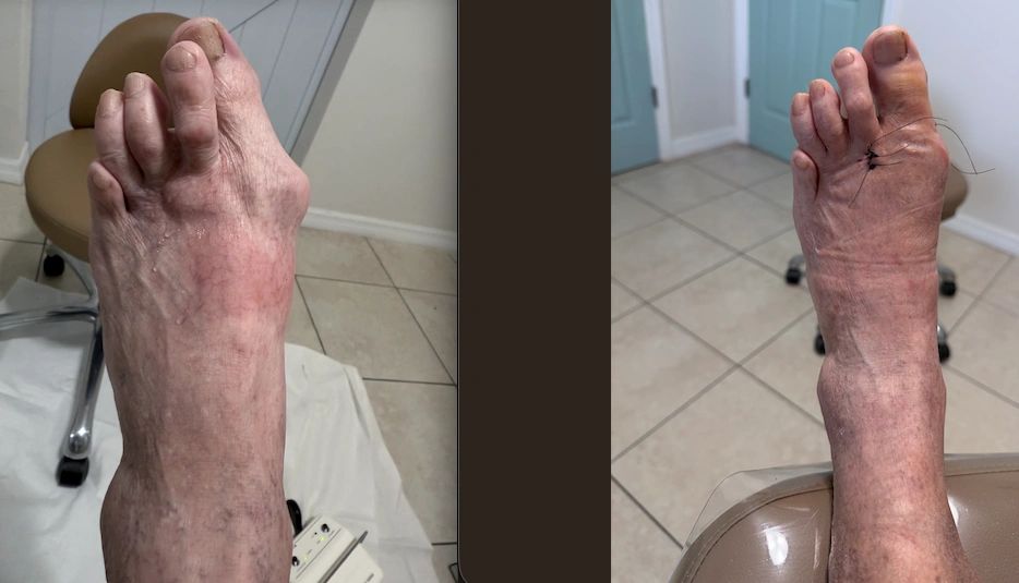 Understanding MIS Bunion Surgery: A Safer, Faster Path to Relief