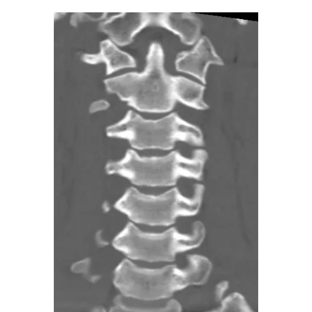 ReVivo Medical - Spinal Fusion, Medical Device