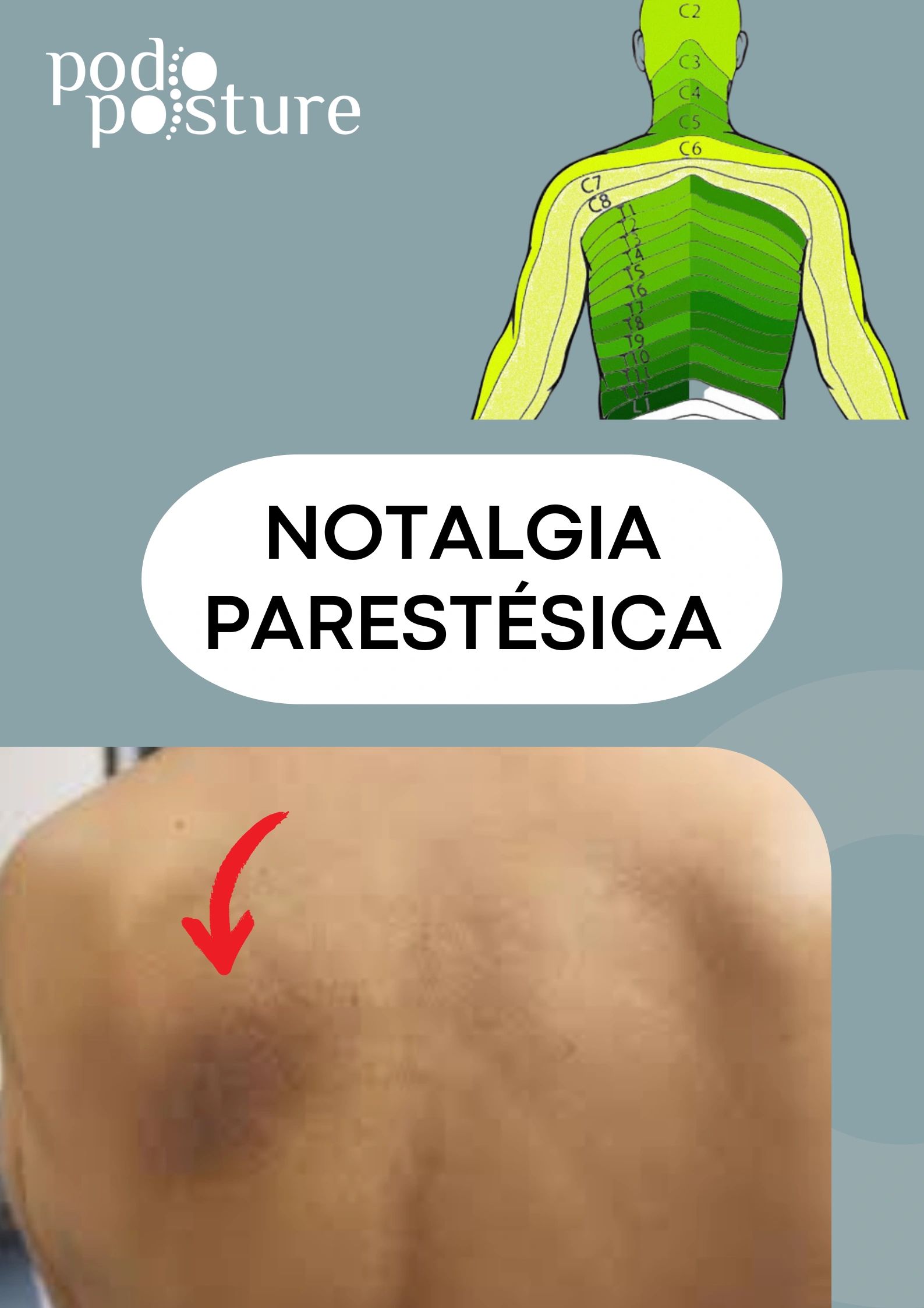 Já ouviu falar em NOTALGIA PARESTÉSICA?