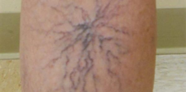 Micro Sclerotherapy | Canadian College of Aesthetic Dermatology