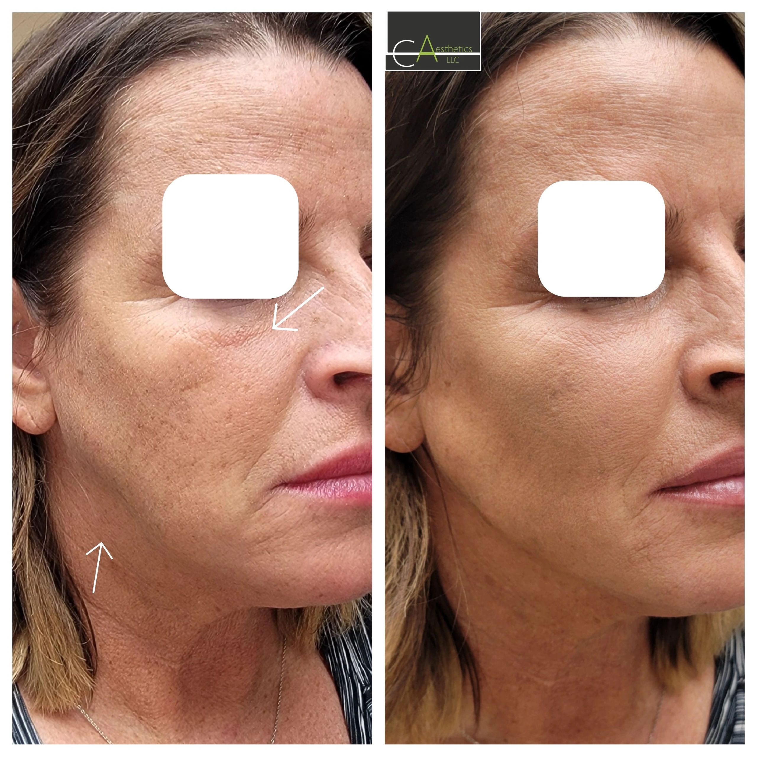 Cheeks, nasolabial folds, undereyes & jaw!
