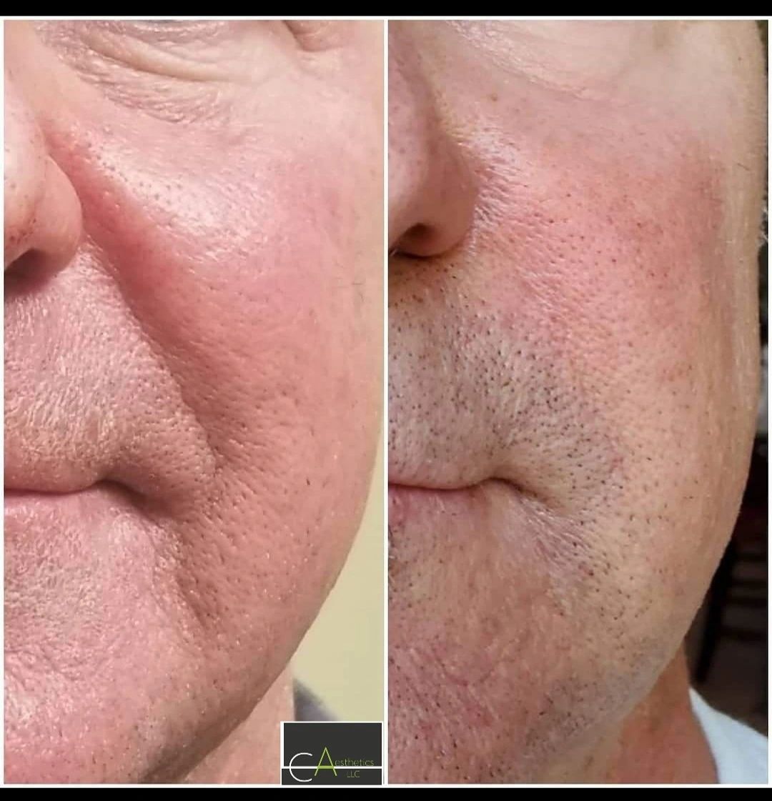 Nasal Nasolabial Folds