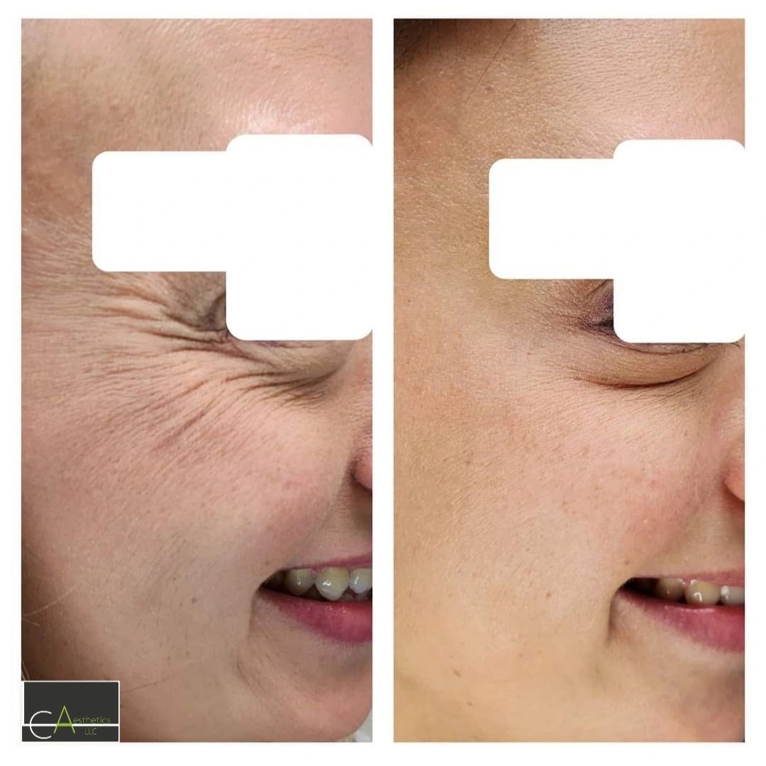 Crow's Feet smile lines