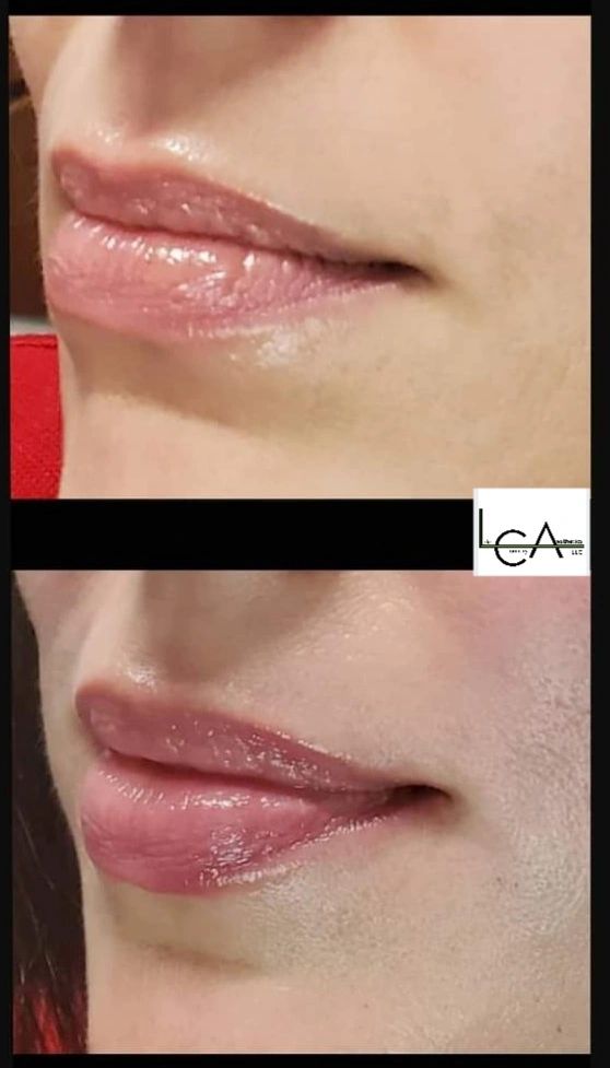 Thread lift lip flip