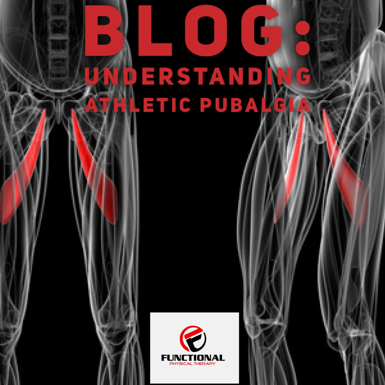 Understanding Athletic Pubalgia