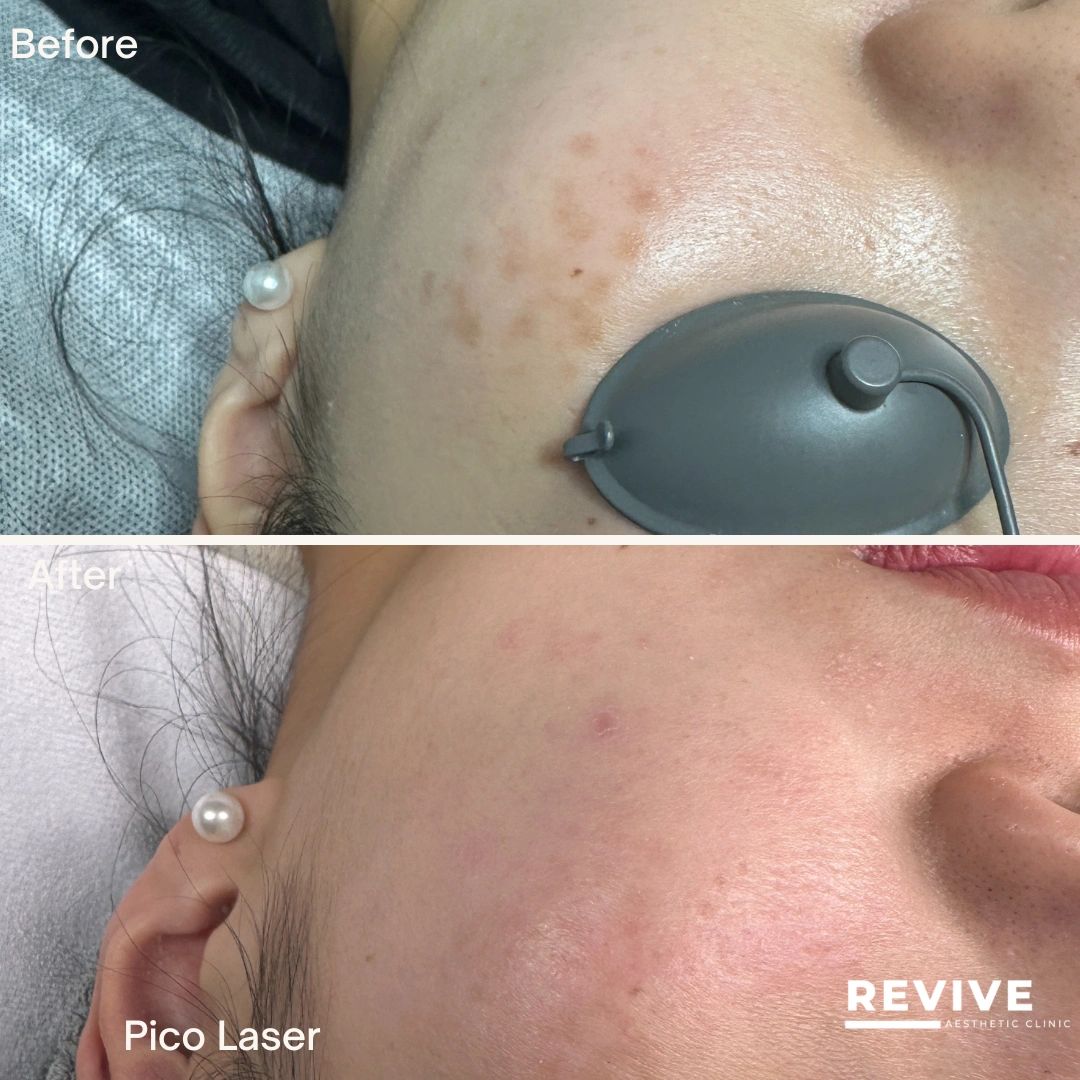 Alma Picoclear PicoToning at Revive Aesthetic Clinic