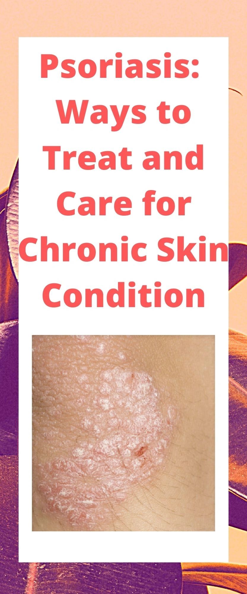 Psoriasis: Chronic Skin Condition