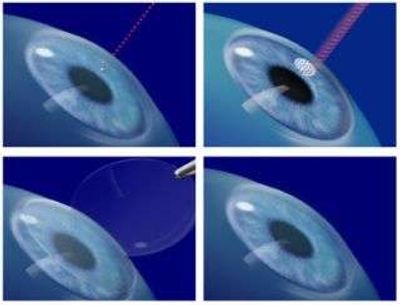 TEXAS EYE PHYSICIANS - Lasik - Arlington, Texas | TEXAS EYE PHYSICIANS