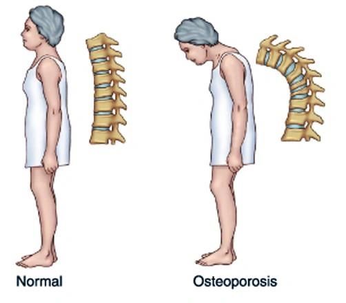 Back Pain from Osteoporotic Fractures