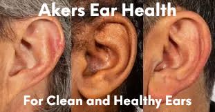 Akers ear and health