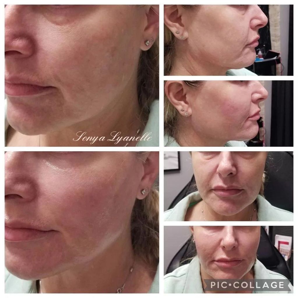 Island Beauty Aesthetics - Filler, Injectable Treatments, Dermal ...