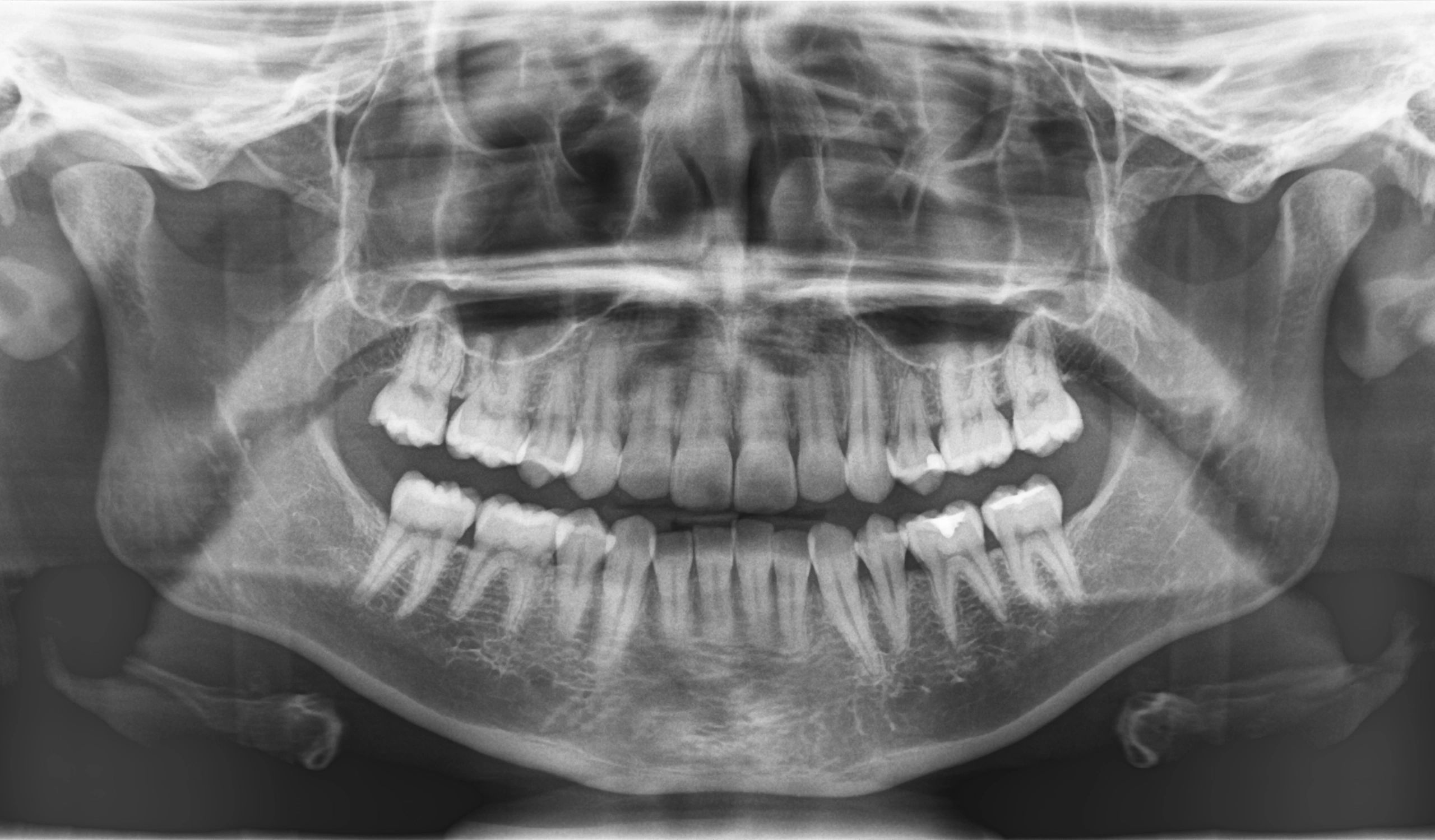 Temporomandibular Joint X Ray
