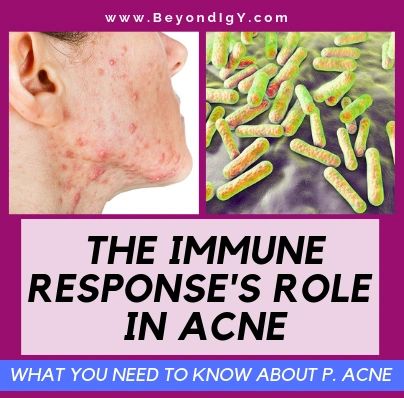 Role of the Immune Response in Acne